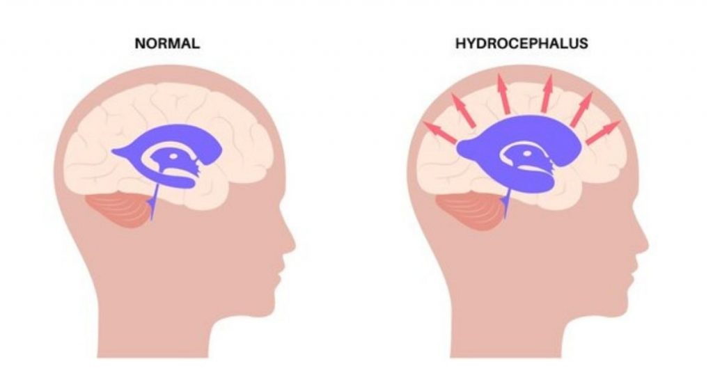 Precautions To Take If You Have Hydrocephalus