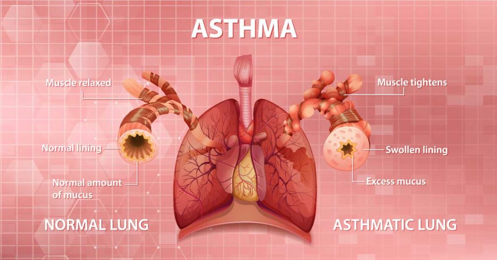 What are the current treatments for asthma?