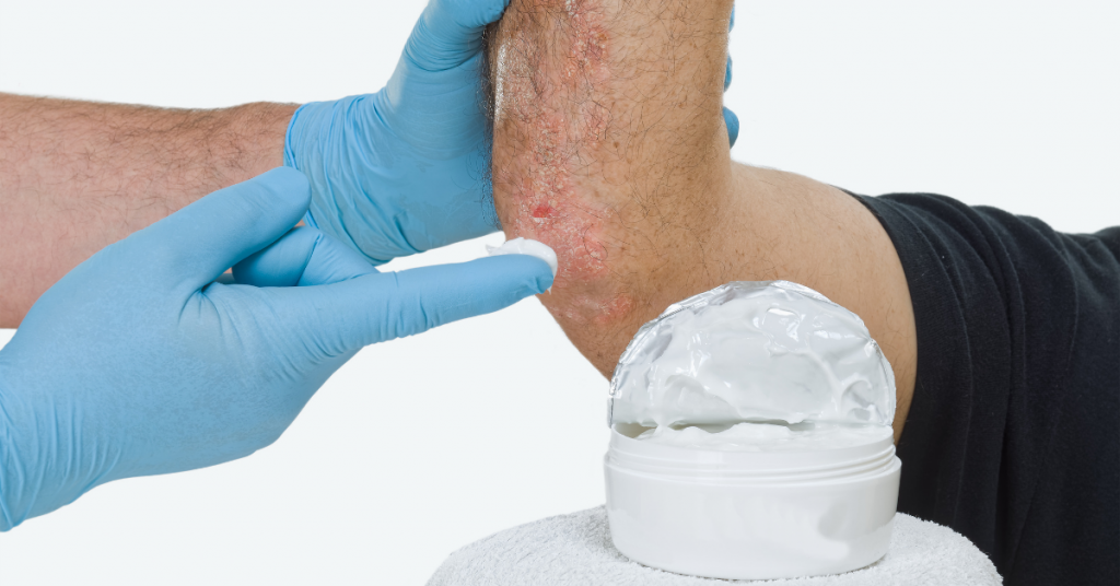 Psoriasis: Early Treatment Benefits