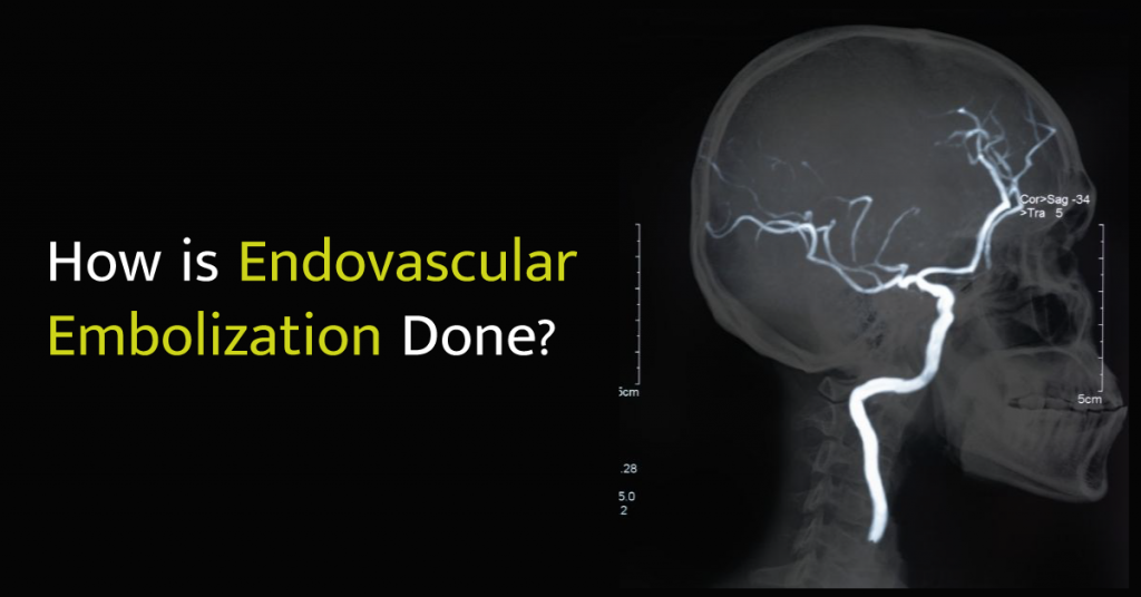 How is endovascular embolization done? | Sri Ramakrishna Hospital