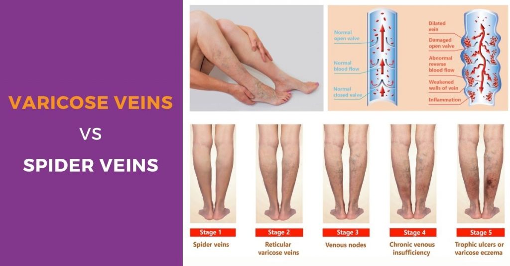 What is difference between spider veins and varicose veins? | Sri ...