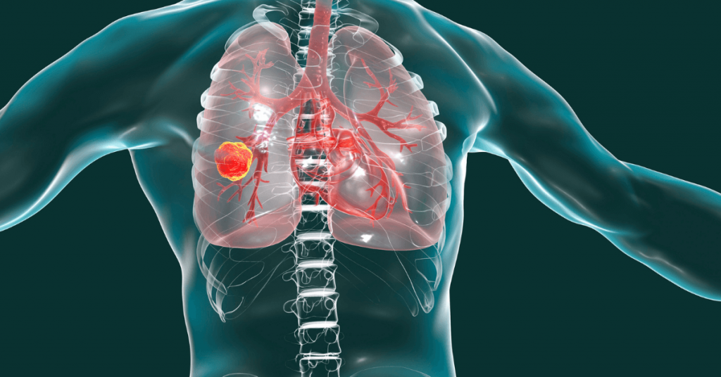 How does lung cancer usually start? | Sri Ramakrishna Hospital