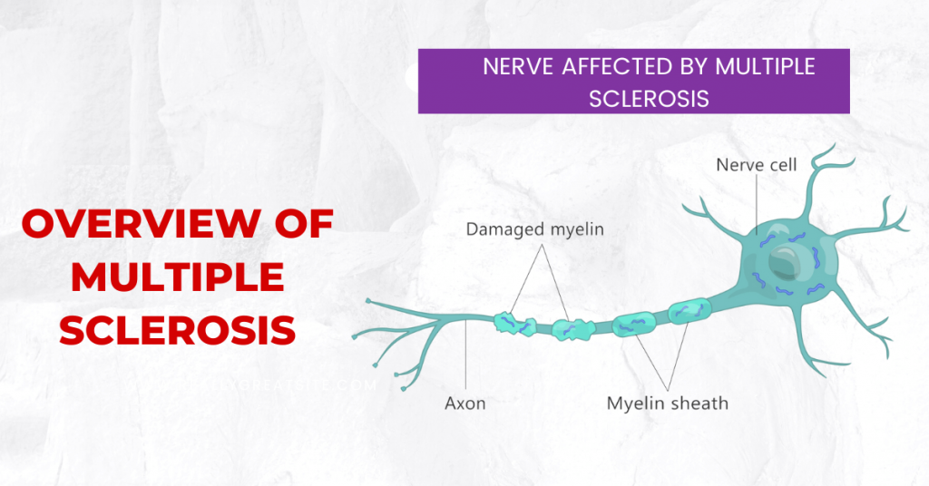In adults, what are the early symptoms of multiple sclerosis? | Sri ...