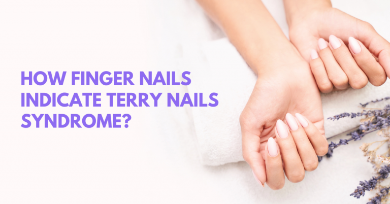 How Finger Nails indicate Terry Nails Syndrome? | Sri Ramakrishna Hospital