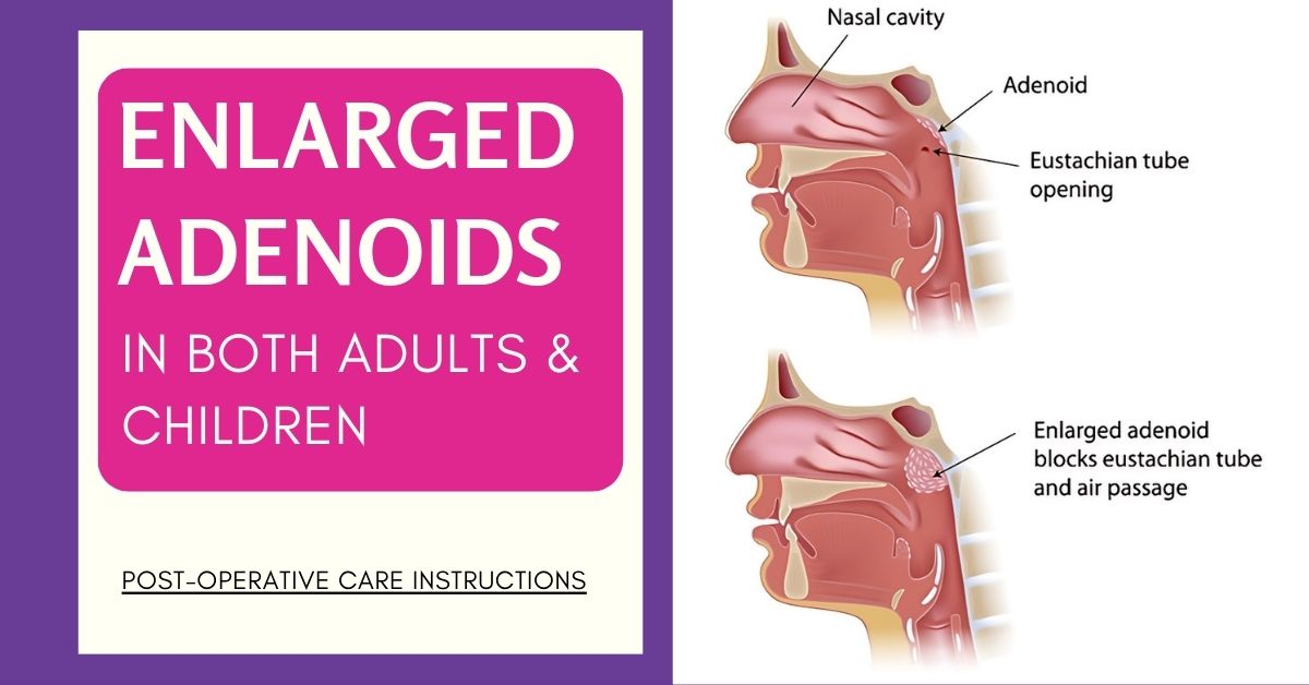 Adenoids Removal