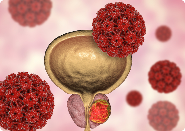 Bladder Cancer Treatment | Bladder Cancer Hospital In Coimbatore