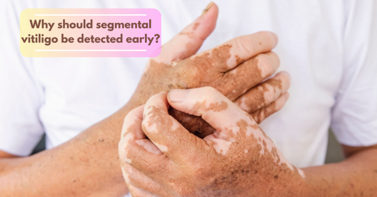 Why should segmental vitiligo be detected early? | Sri Ramakrishna Hospital