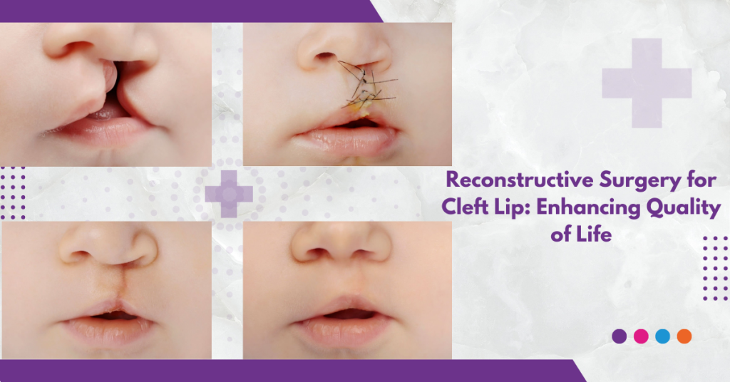 Reconstructive Surgery for Cleft Lip: Enhancing Quality of Life