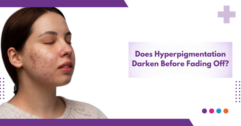 Does Hyperpigmentation Darken Before Fading Off?