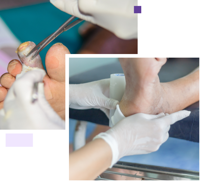 Diabetic Foot Ulcer Treatment in Coimbatore