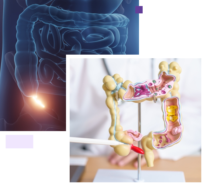 Appendix Surgery in Coimbatore | Appendix Hospital in Coimbatore