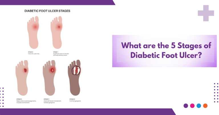 What are the 5 Stages of Diabetic Foot Ulcer?