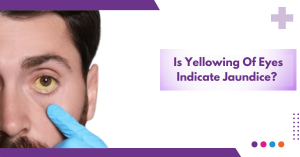 Is Yellowing Of Eyes Indicate Jaundice?