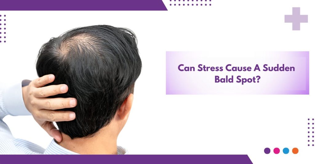 Can Stress Cause A Sudden Bald Spot