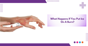 What happens if you put ice on a burn?
