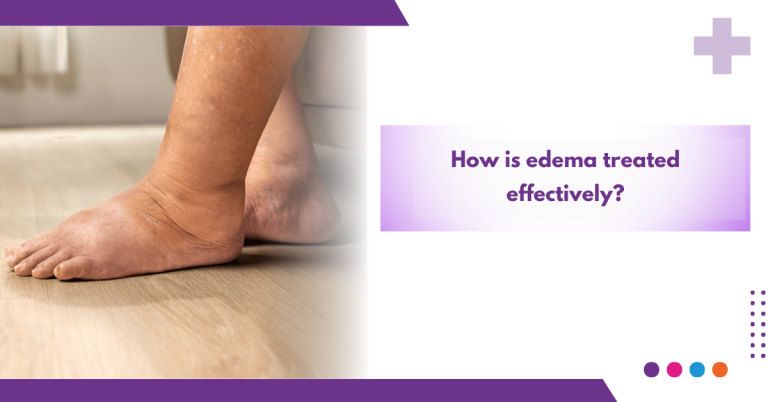 How Is Edema Treated Effectively? - Sri Ramakrishna Hospital